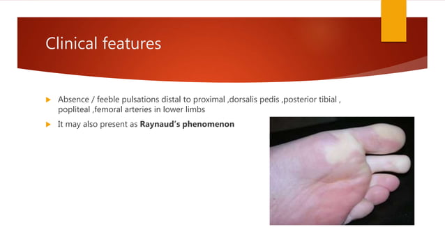 Buergers Disease Ppt