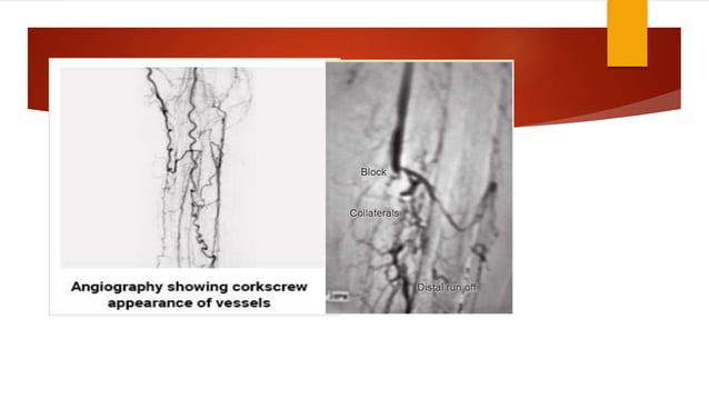 Buergers Disease Ppt