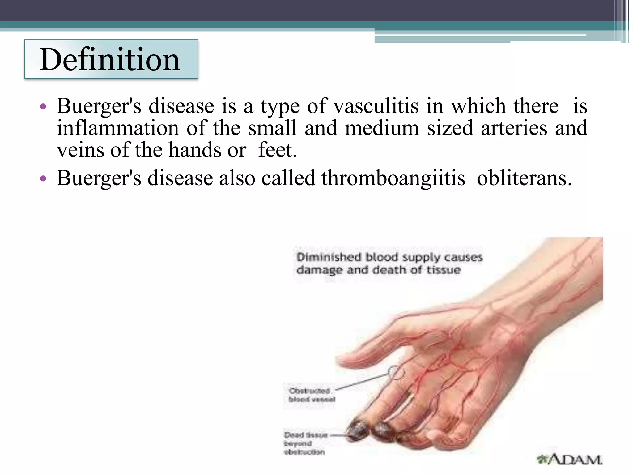 Buerger's disease | PPTX | Blood Disorders | Diseases and Conditions