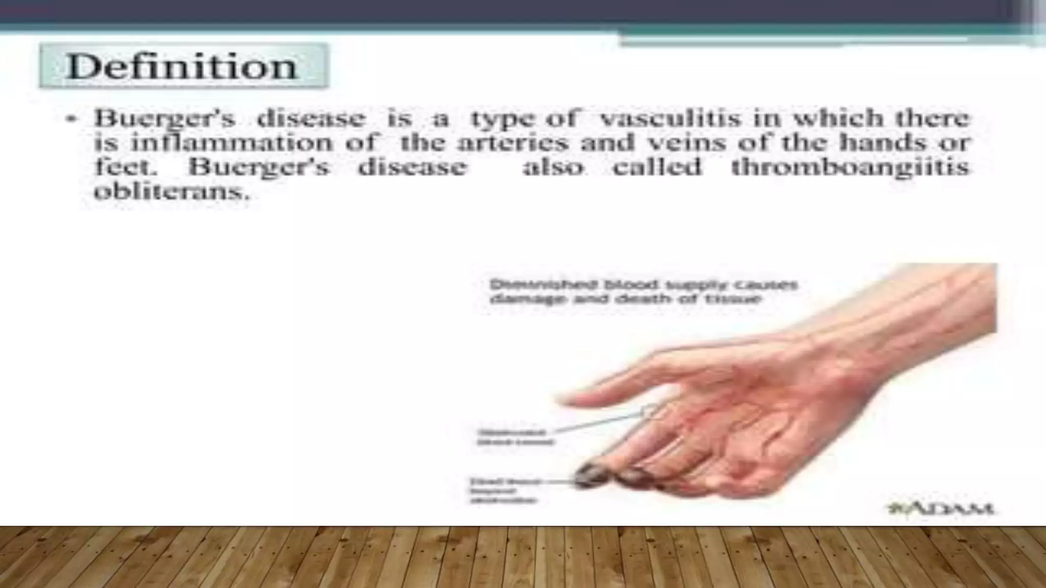 Buerger’s disease.pdf