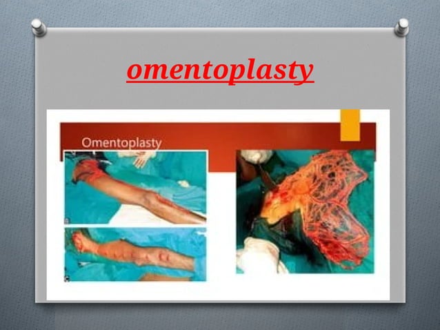 Buerger's disease medium sized vasculitis.pptx