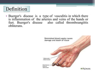 Buerger's disease ( Thromboangiitis obliterans) | PDF