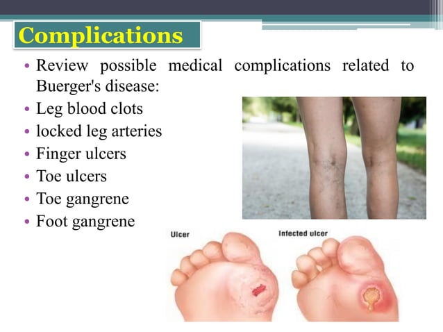 Buerger's disease ( Thromboangiitis obliterans) | PDF