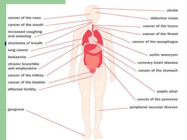 Buergers Disease By Dr Ravinder Narwal Ppt
