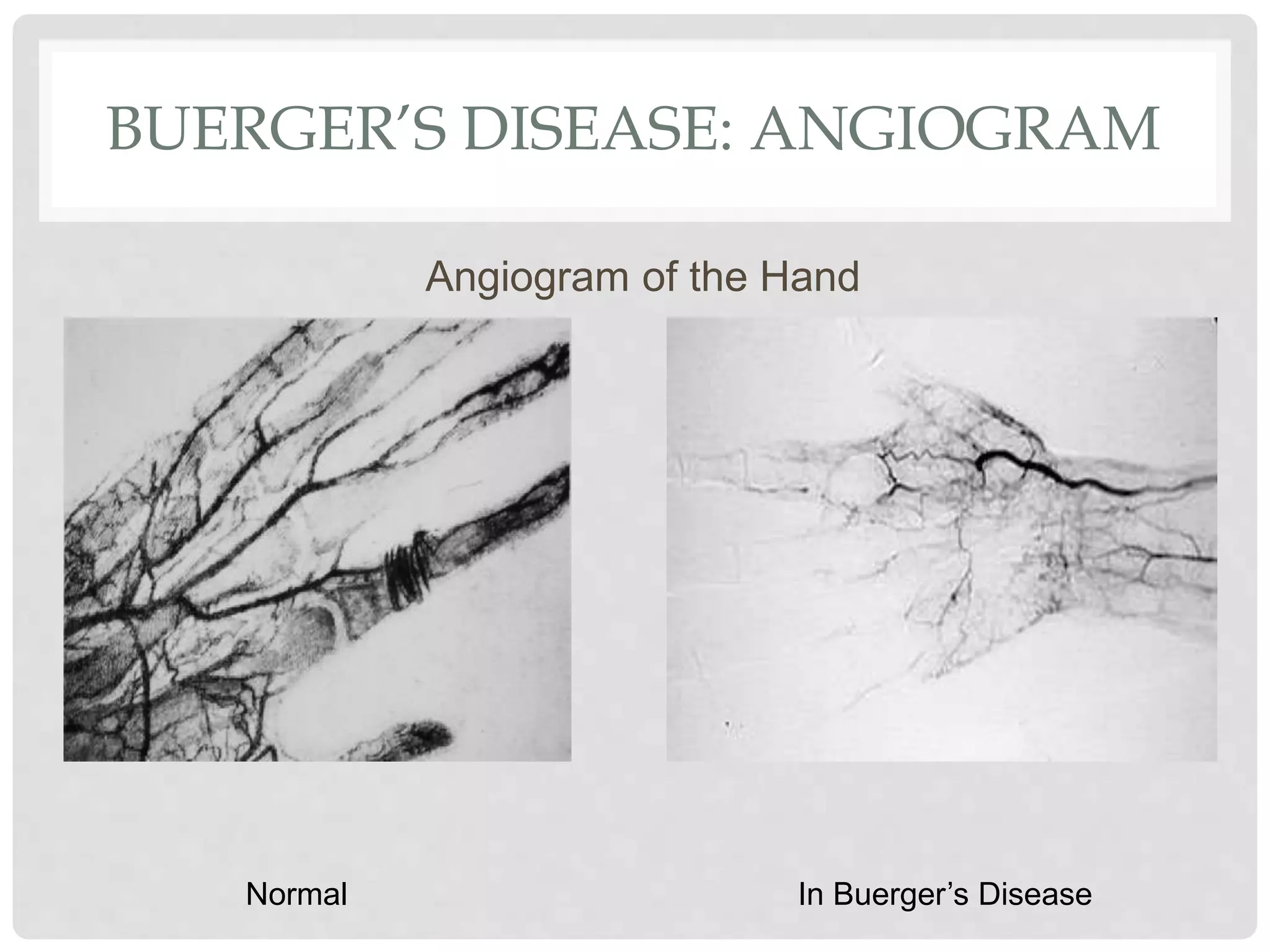 Buergers disease facts | PPTX