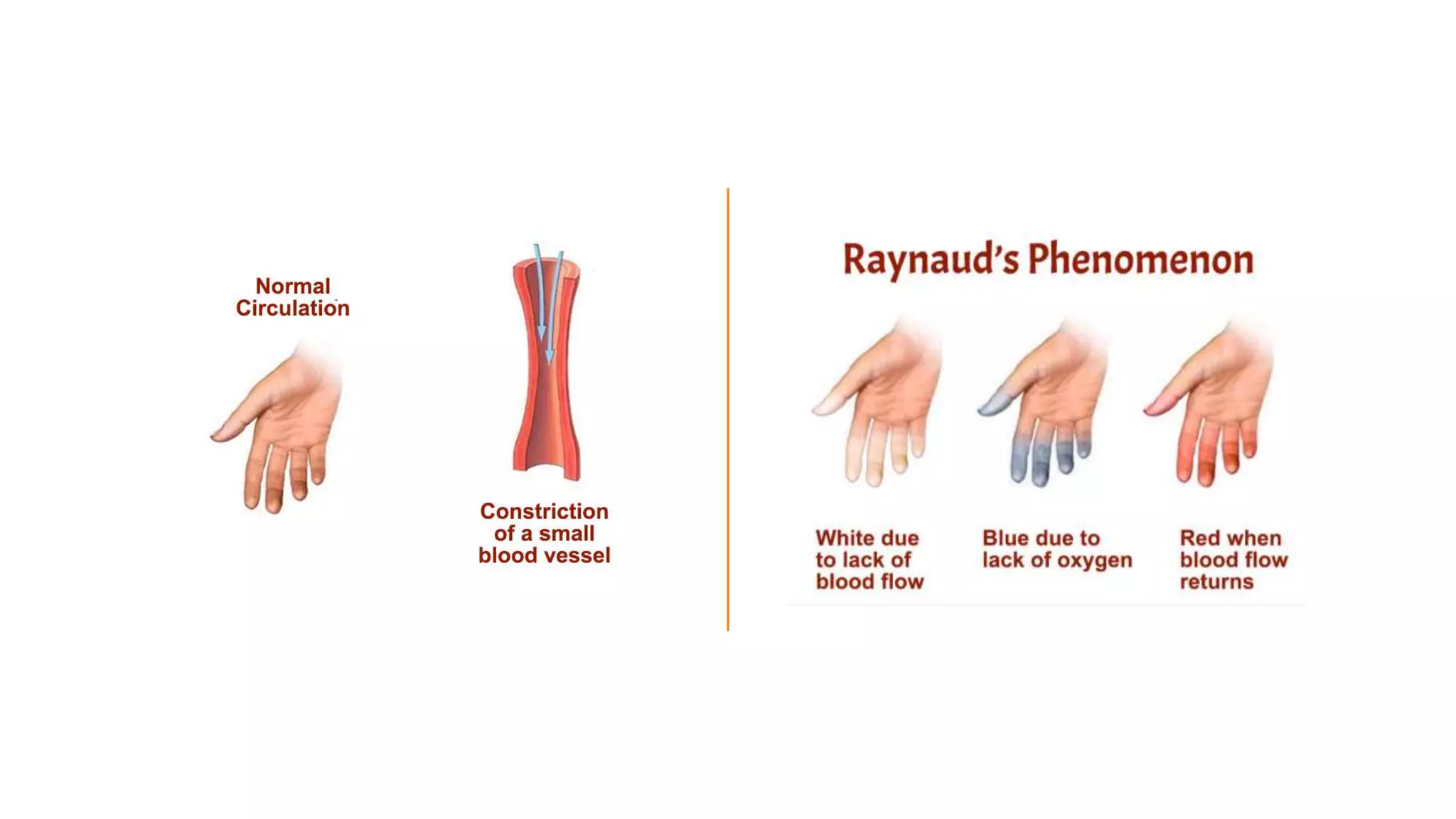 Buerger’s Disease (Thromboangiitis Obliterans) | PPTX