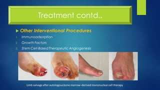 Buerger's disease, Thromboangitis obliterans | PDF