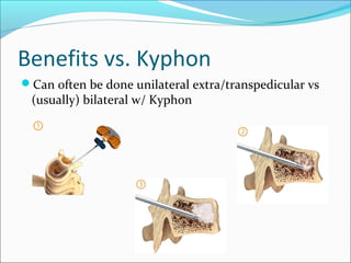 RF Kyphoplasty | PPT