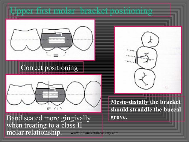 Building treatment mechanics through brackets /certified fixed orthod…