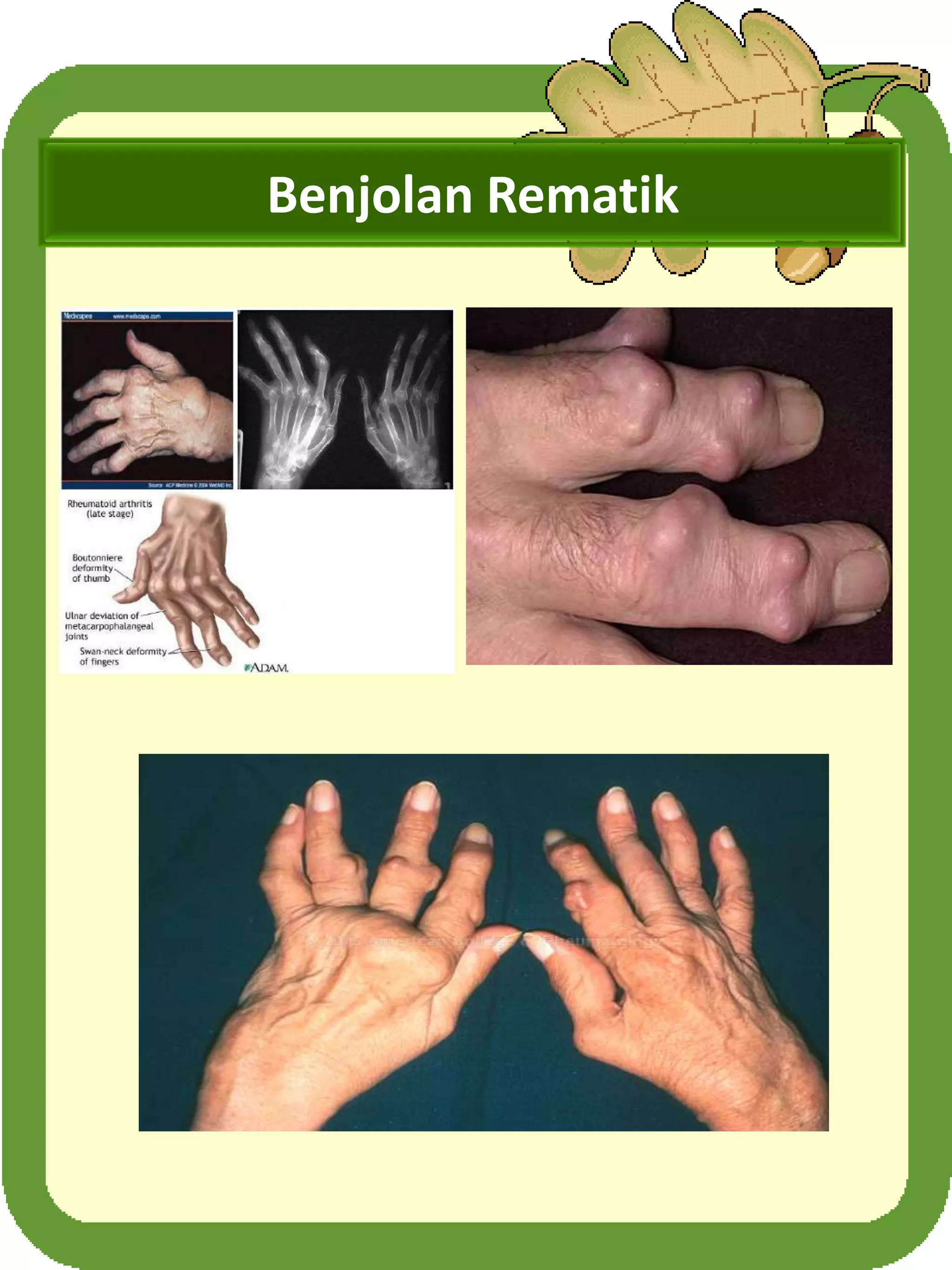 Buku saku artritis reumatoid | PPTX