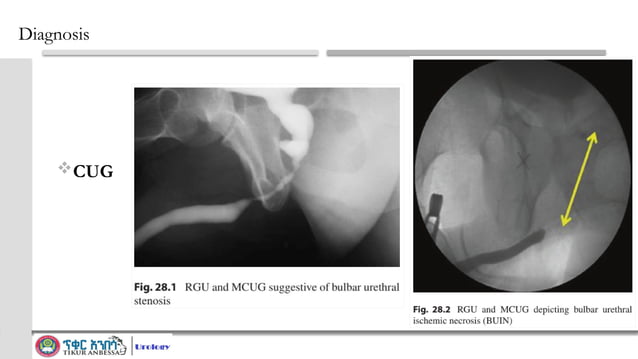 Bulbar Urethral Necrosisssssssssssssssssssssss.pptx