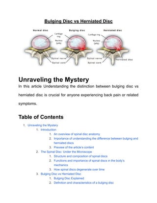 Bulging Disc Vs Herniated Disc Whats The Difference