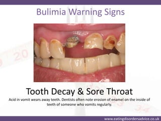 Bulimia warning signs | PDF