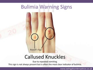 Bulimia warning signs | PDF