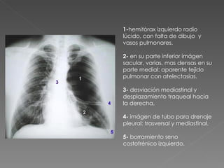 Bullas (Bulas) | PPT