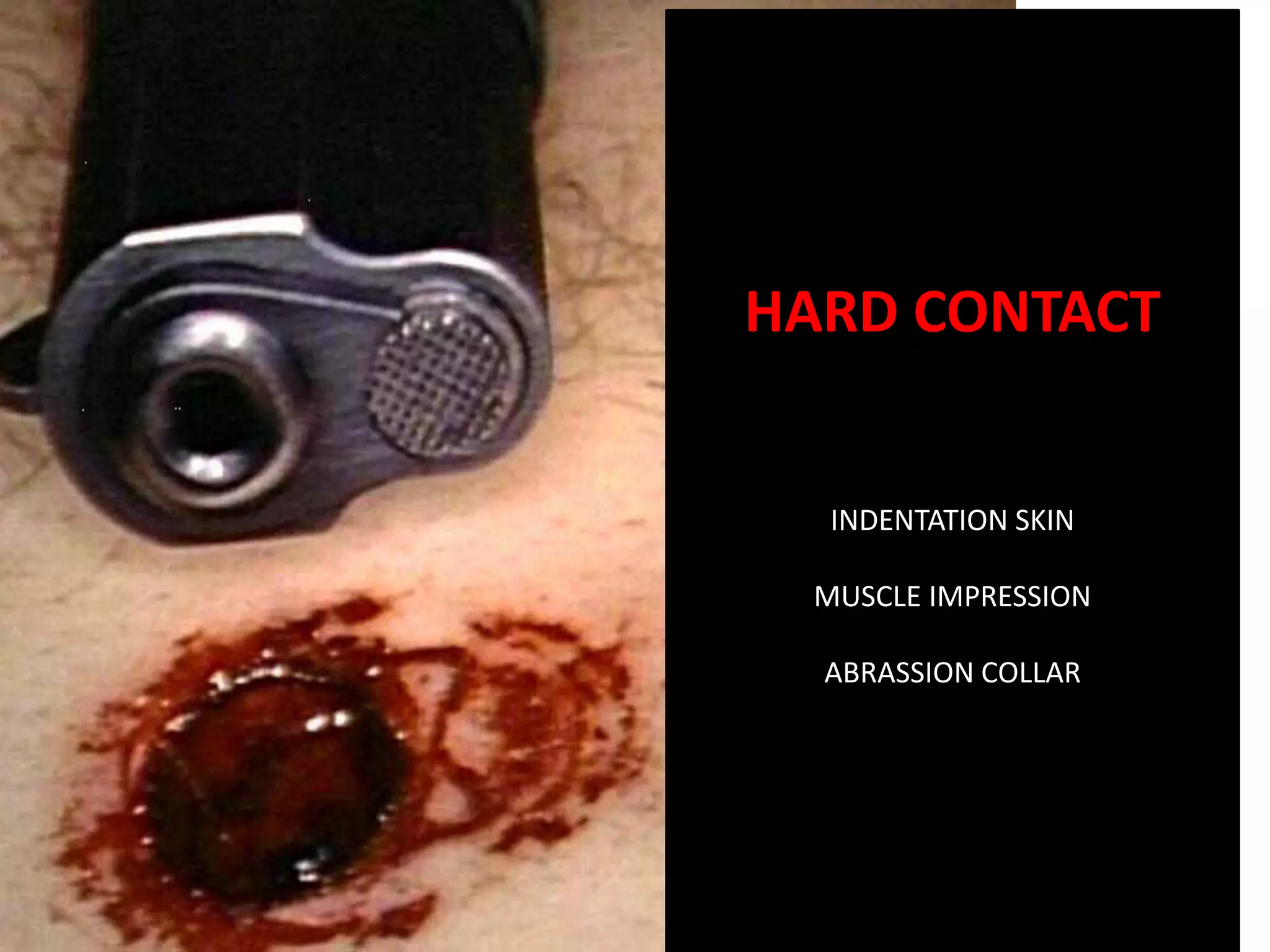 Bullet injuries explained with animation | PPT