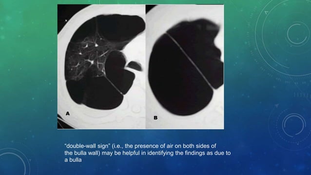 BULLOUS DISEASENOF THE LUNG.pptx high yield topic | PPT