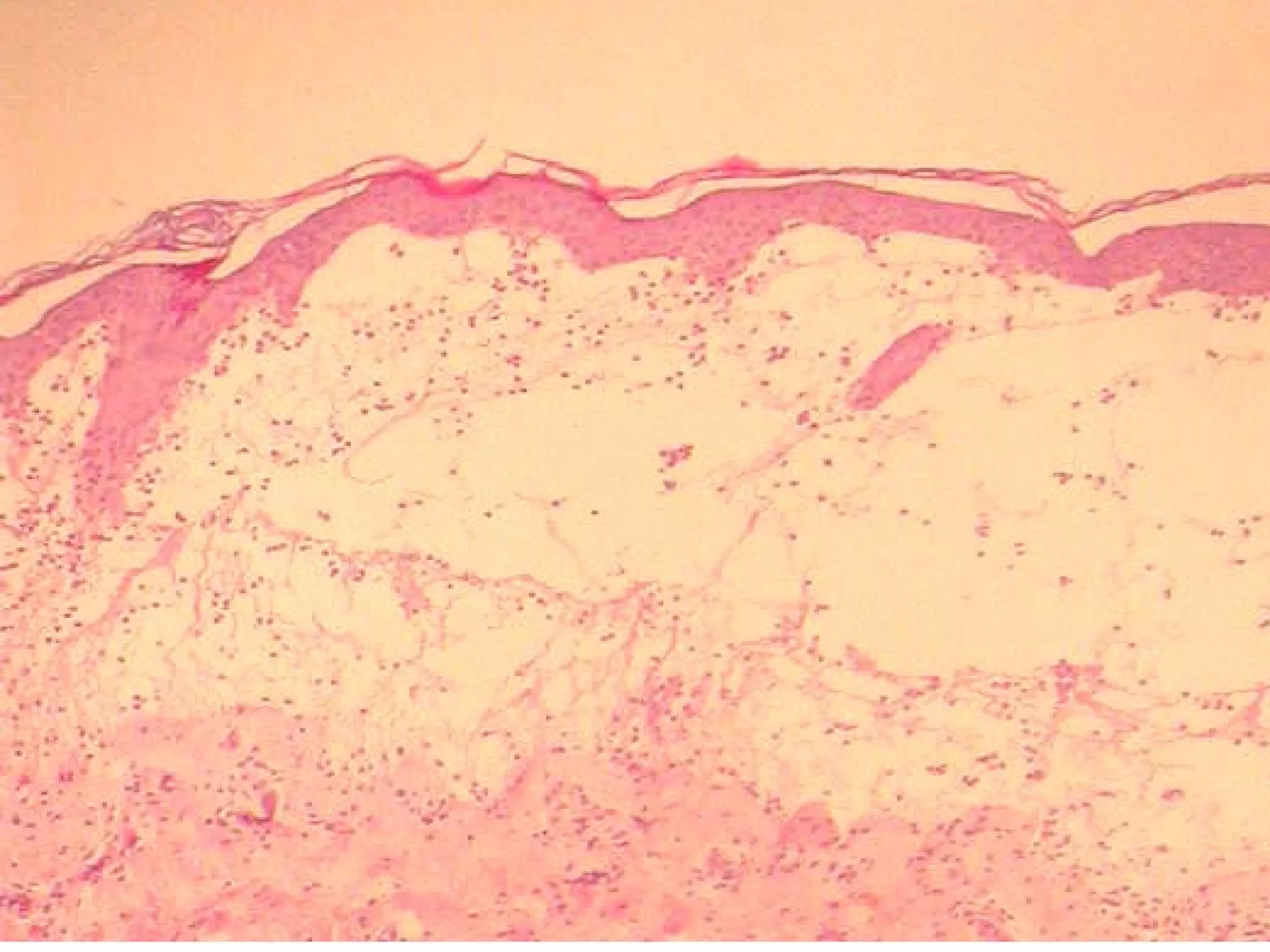 Linear IgA bullous dermatosis II | PPT