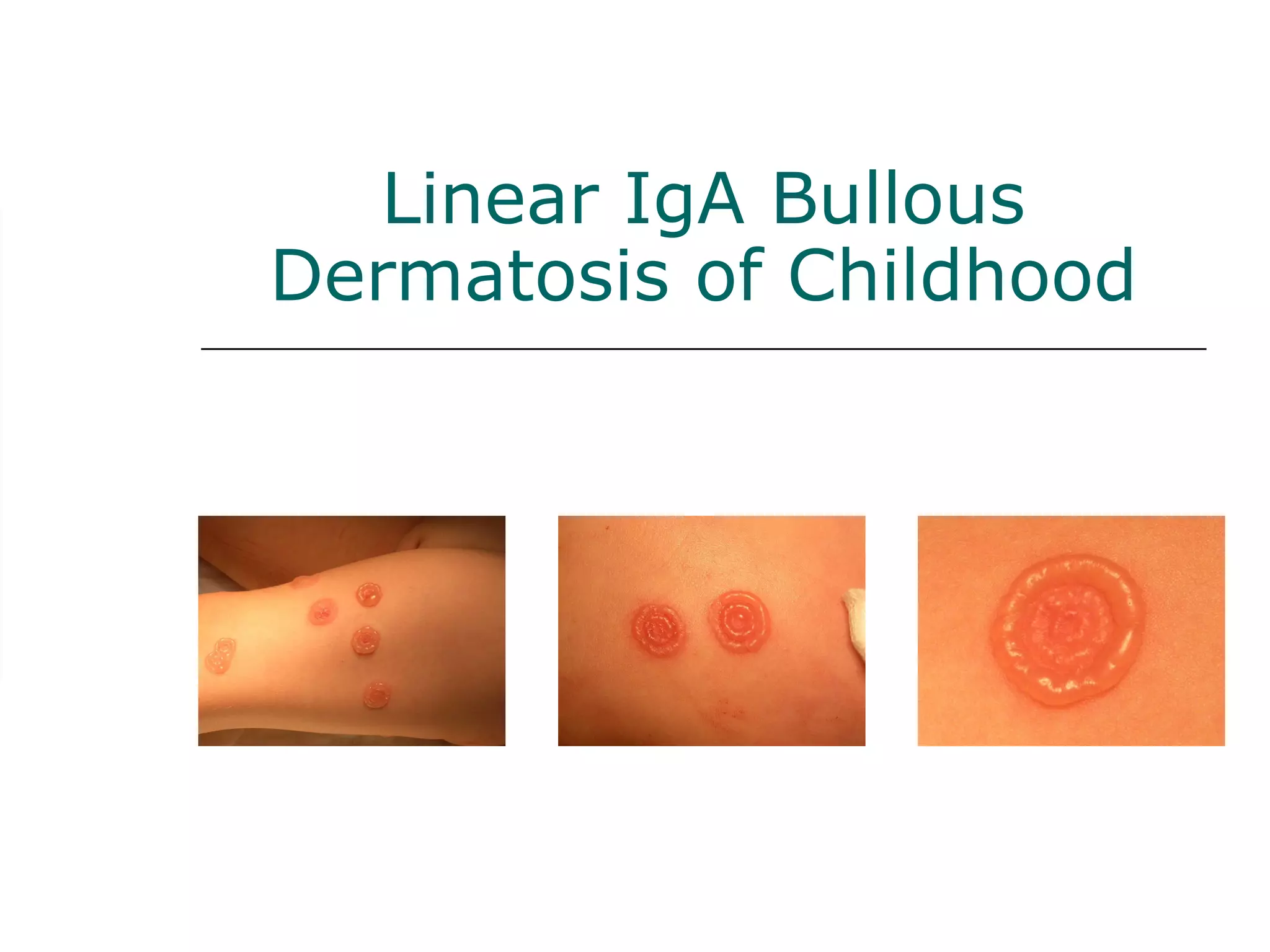 Linear IgA bullous dermatosis II | PPT