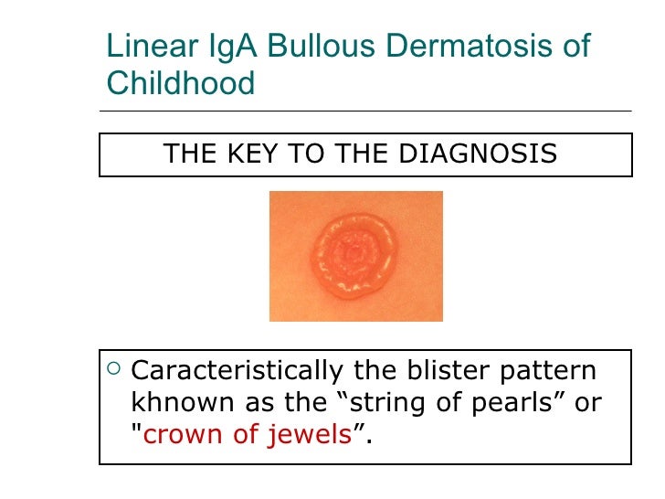Linear IgA bullous dermatosis II