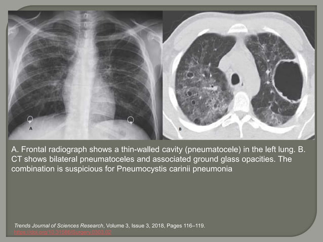 Bullous disease of lung.pptx | Lung and Respiratory Health | Diseases ...
