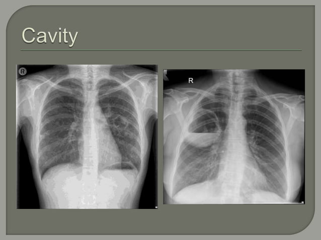 Bullous disease of lung.pptx | Lung and Respiratory Health | Diseases ...