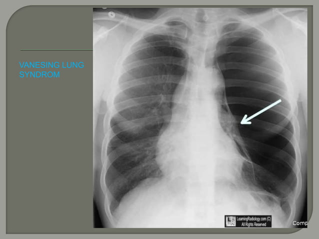 Bullous disease of lung.pptx | Lung and Respiratory Health | Diseases ...