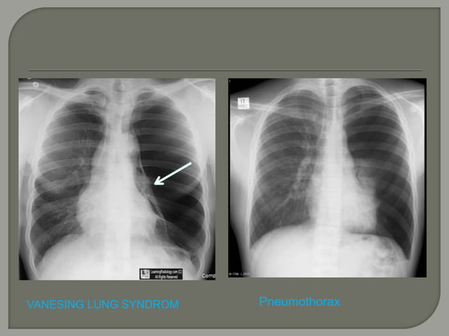 Bullous disease of lung.pptx | Lung and Respiratory Health | Diseases ...