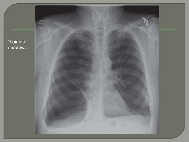 Bullous disease of lung.pptx | Lung and Respiratory Health | Diseases ...