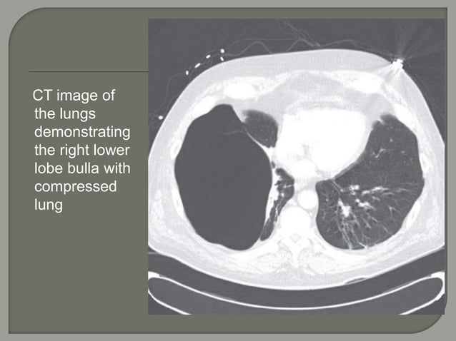 Bullous disease of lung.pptx | Lung and Respiratory Health | Diseases and Conditions