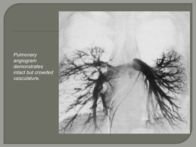 Bullous disease of lung.pptx | Lung and Respiratory Health | Diseases ...