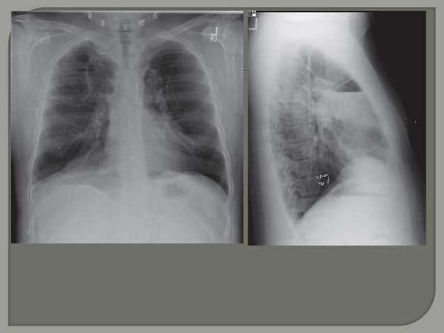 Bullous disease of lung.pptx | Lung and Respiratory Health | Diseases ...
