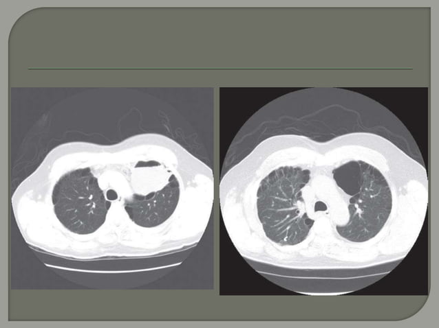 Bullous disease of lung.pptx | Lung and Respiratory Health | Diseases ...
