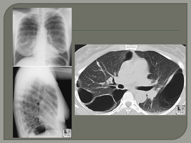 Bullous disease of lung.pptx | Lung and Respiratory Health | Diseases ...