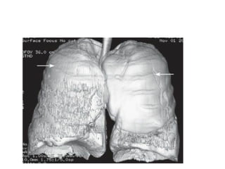 Bullous Disease of the Lung pulmonary medicine | PPTX