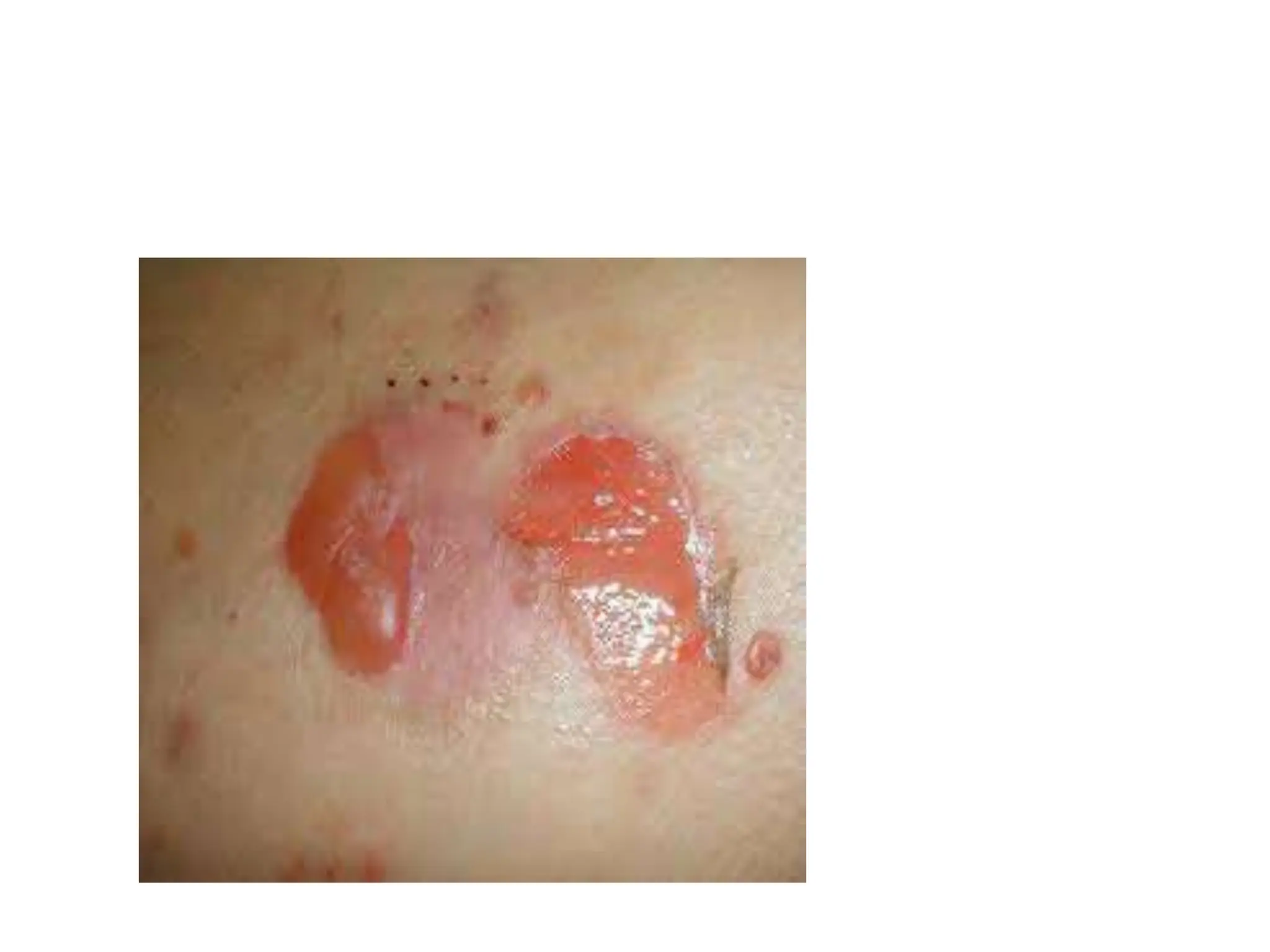 Bullous disease of the skin.pptx