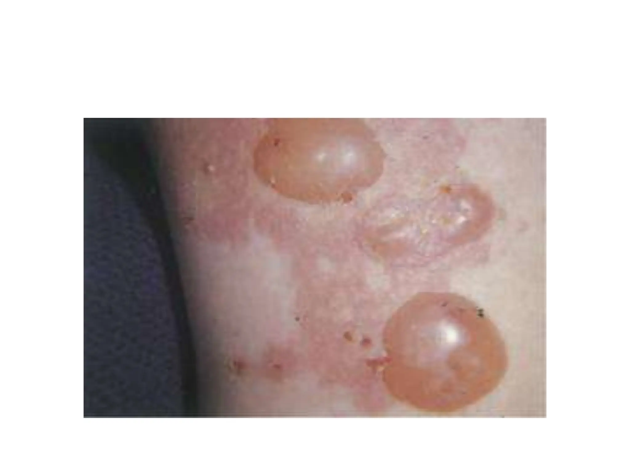 Bullous disease of the skin.pptx