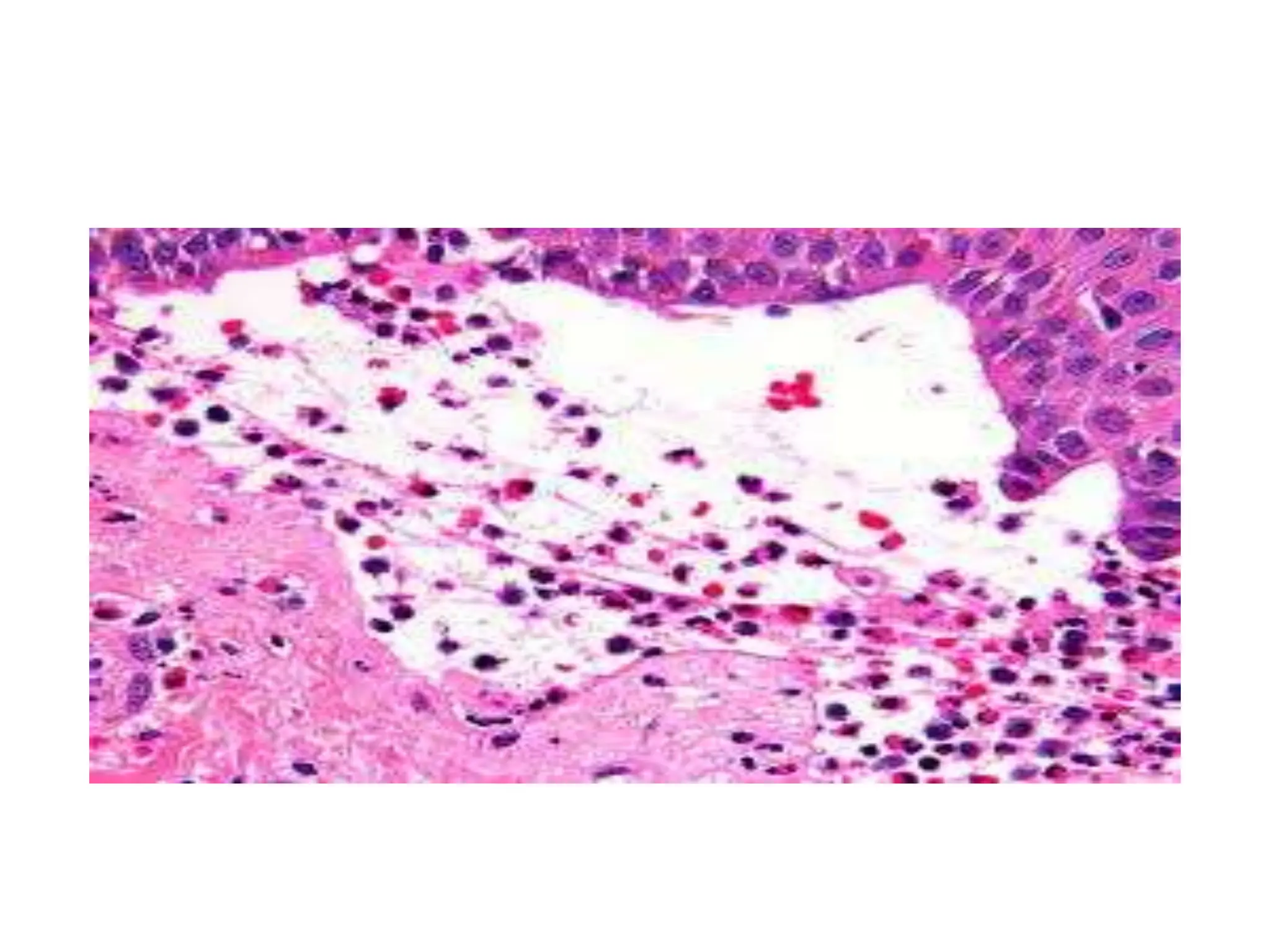 Bullous disease of the skin.pptx