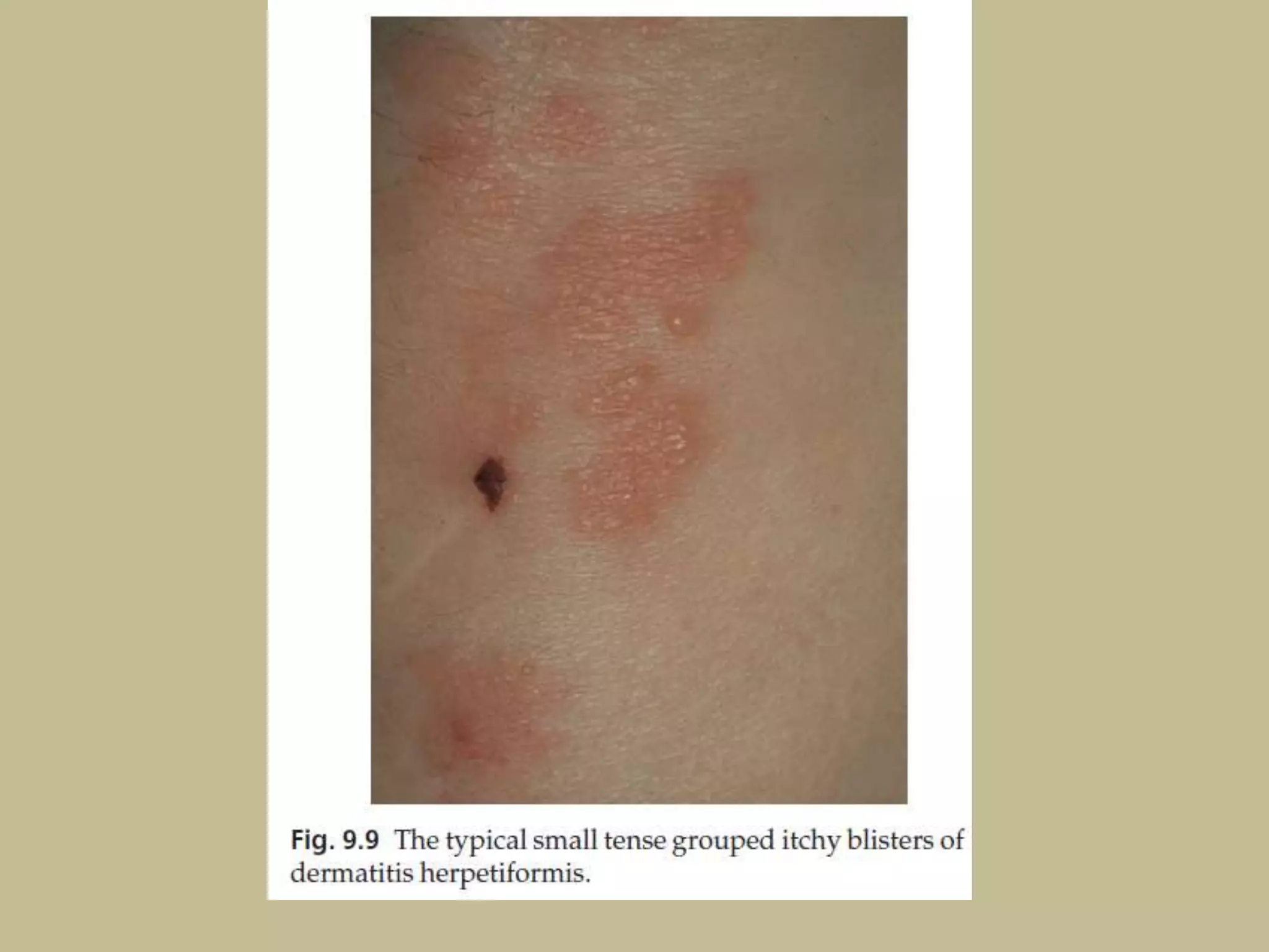 Bullous diseases | PPTX