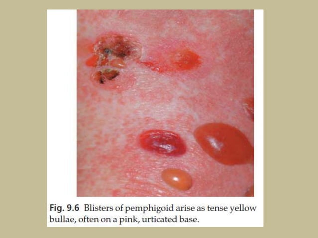 Bullous diseases | PPTX