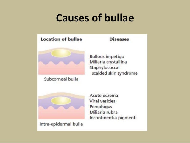 Bullous diseases