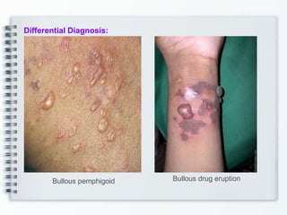 BULLOUS_DISEASES presentation and management | PPT