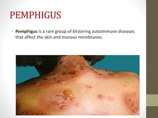 Bullous disorders | PPTX