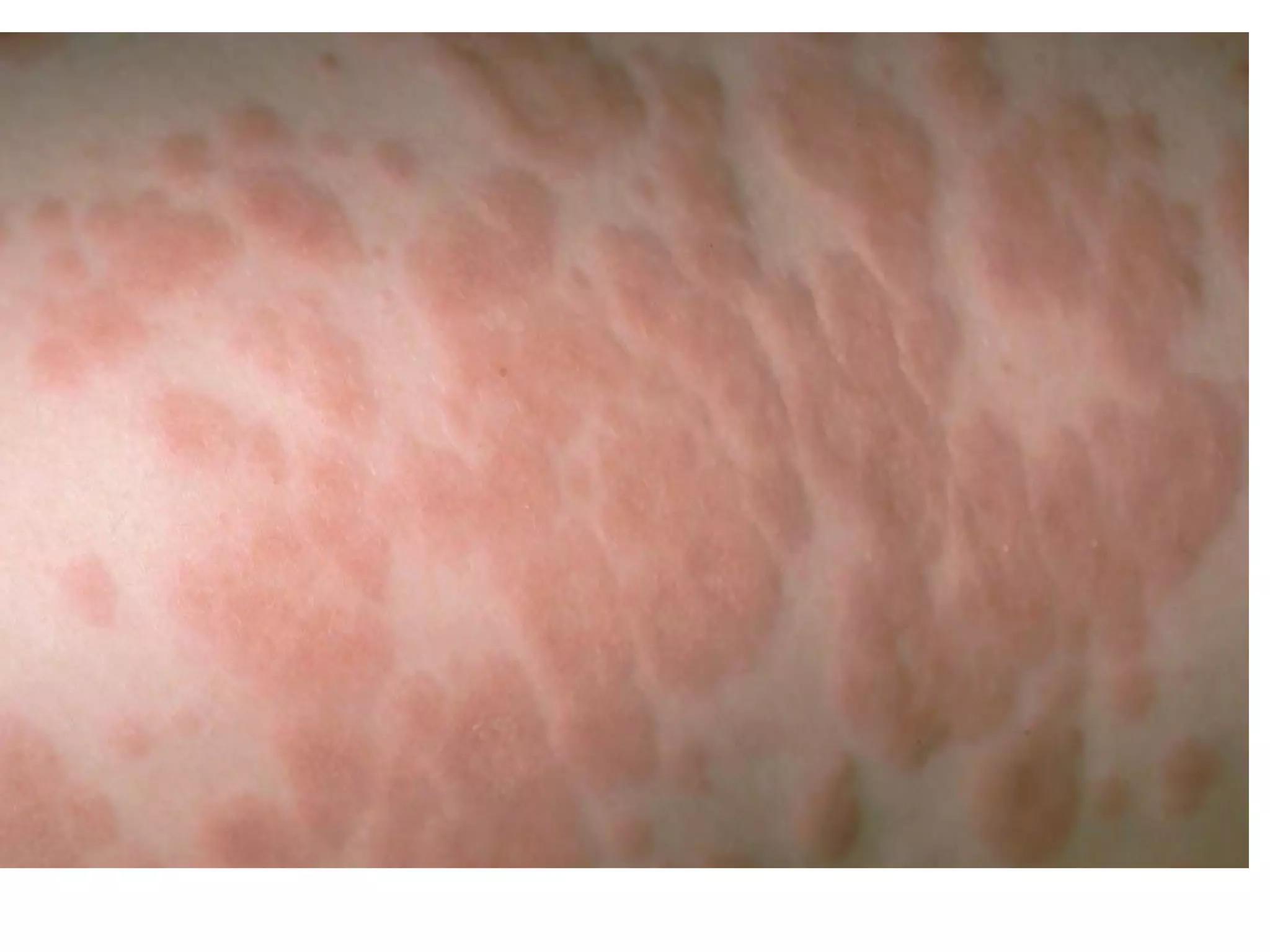 Bullous lesions.pdf