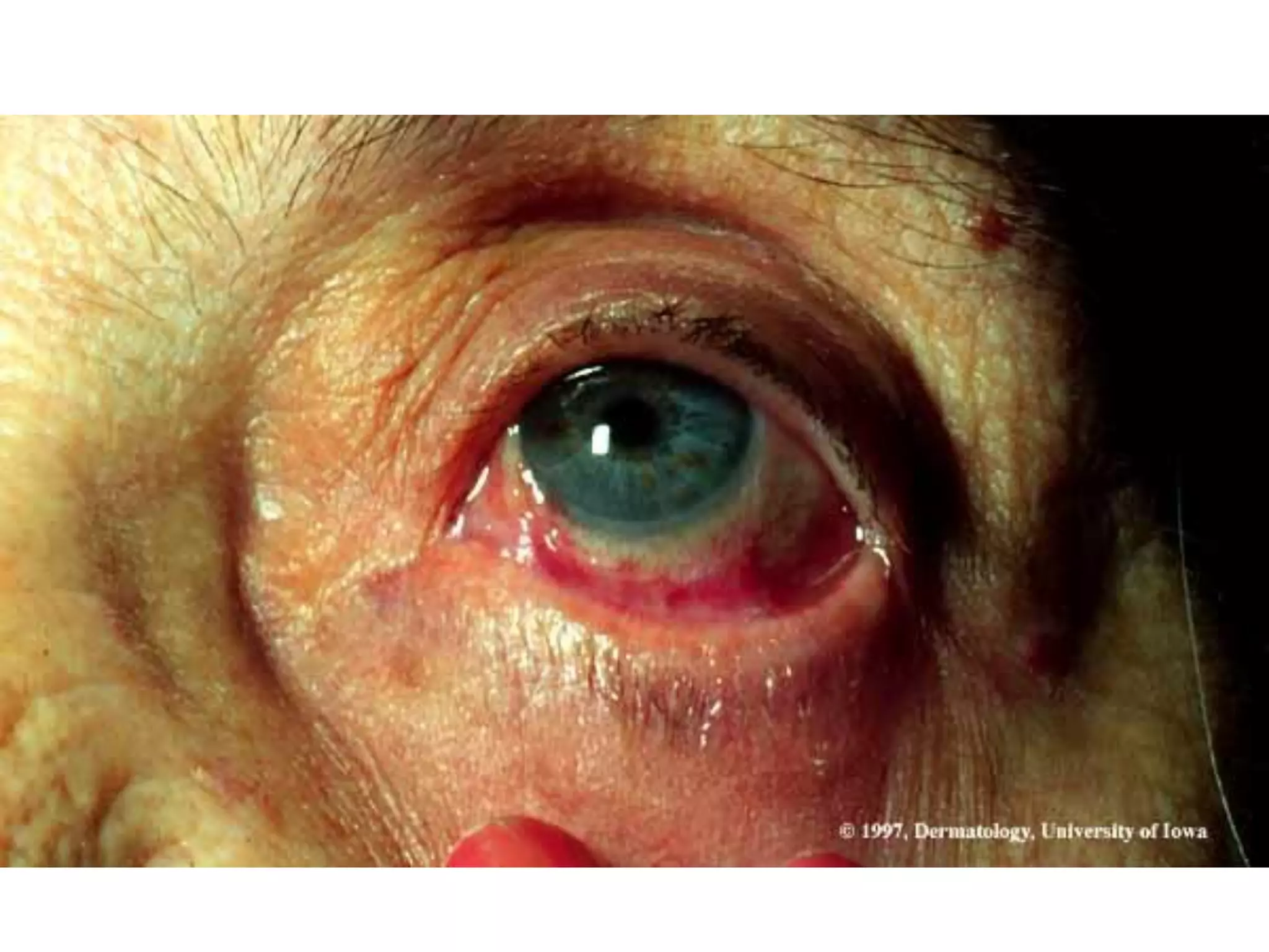 Bullous lesions.pdf