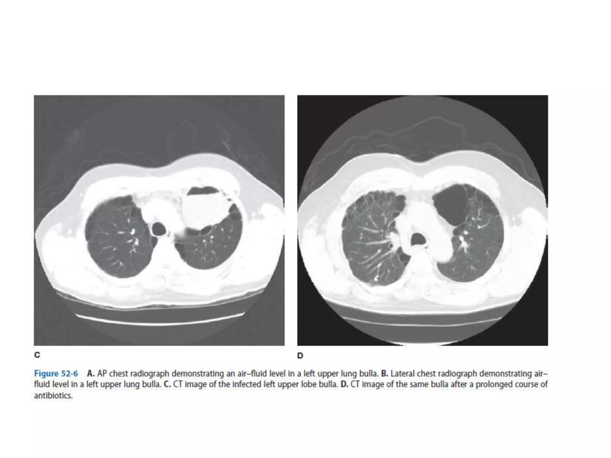 Approach to Bullous lung disease | PPT
