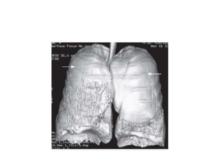 Approach to Bullous lung disease | PPT