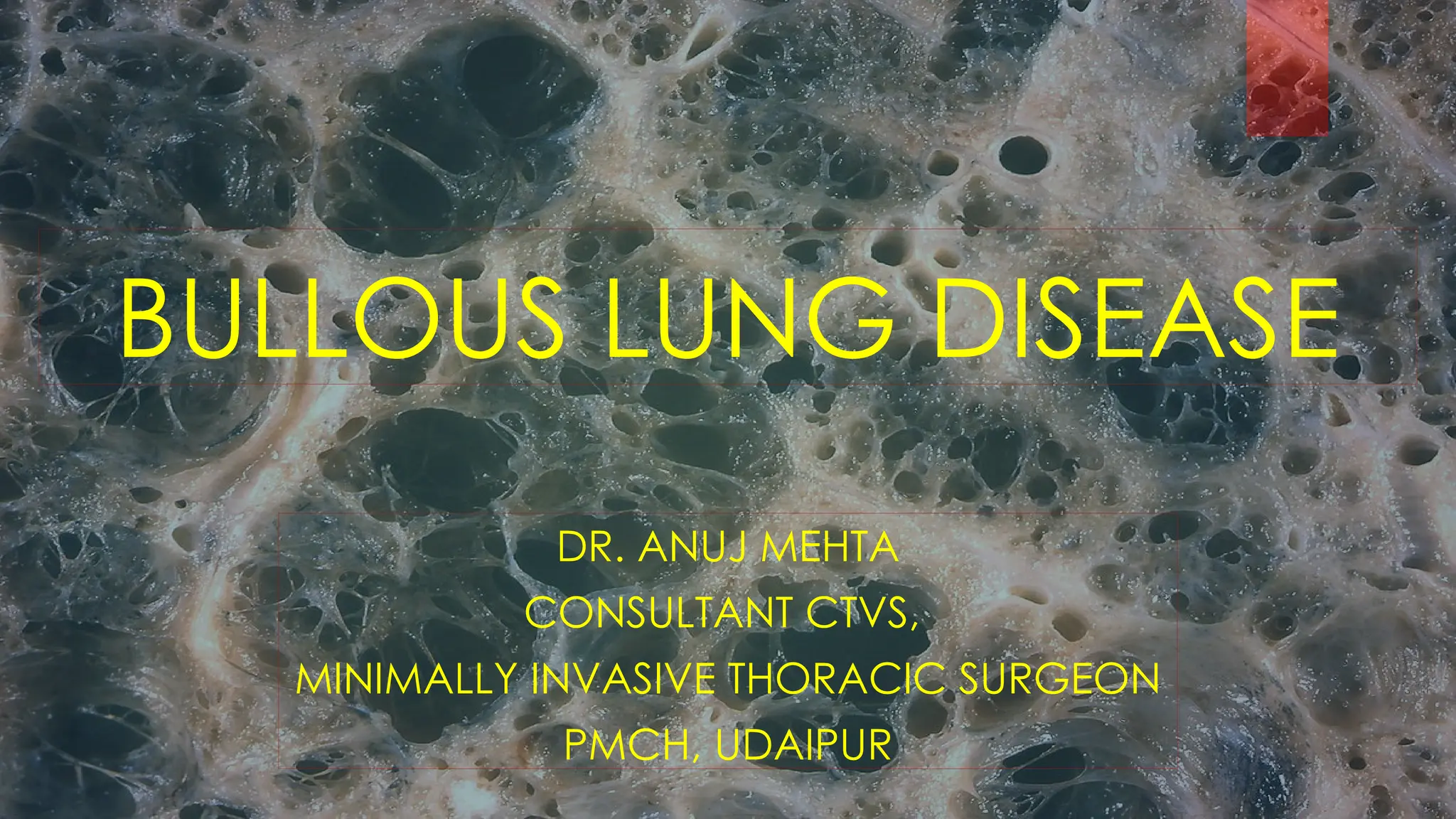 Bullous Lung Disease – Clinical, Radiological and Surgical Perspectives ...