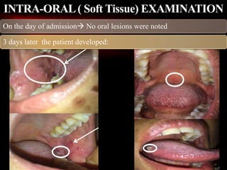 Bullous Pemphigoid | PPTX