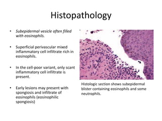 Pemphigoid Histology